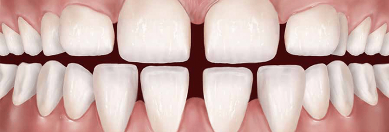 Gaps Between Teeth: Causes And Solutions